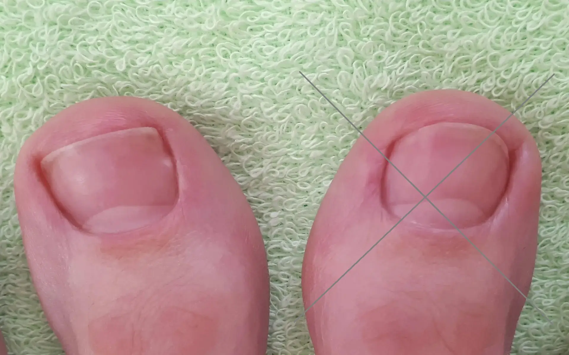 Zarostlý nehet - Profesionální pedikúra Beroun Beroun, Markéta Šírerová